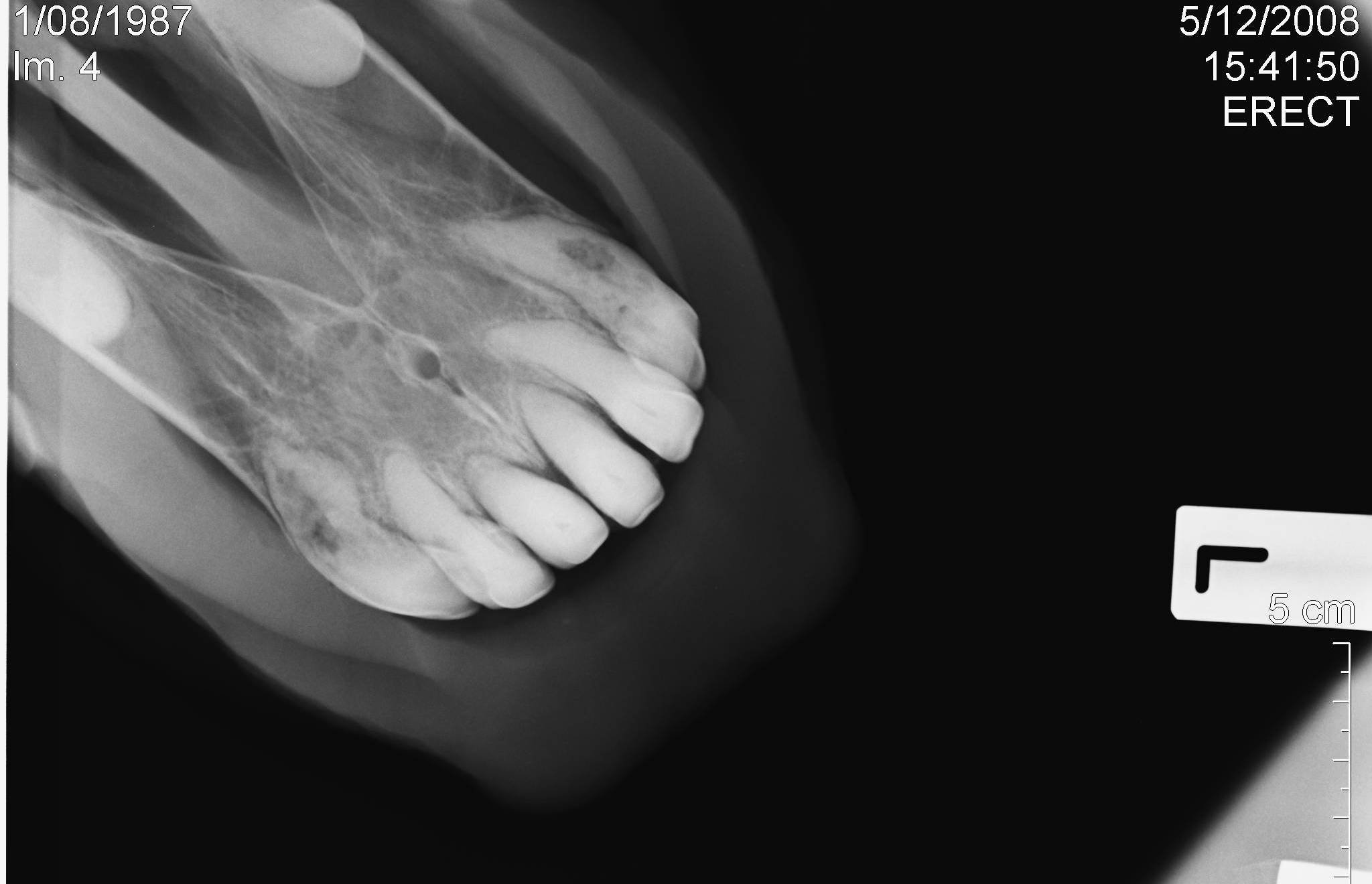 Equine Odontoclastic Tooth Resorption & Hypercementosis, EOTRH - Horse ...